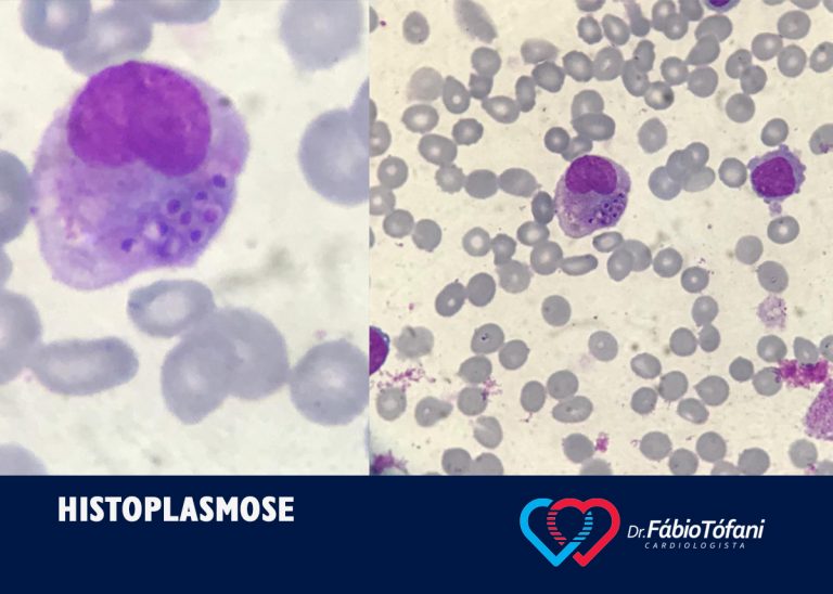 Histoplasmose em Paciente Transplantado – Dr. Fábio Ávila Tófani